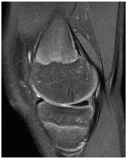 Procedure of the Month - SmartNail Fixation