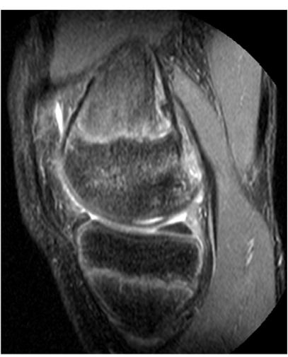Procedure of the Month - SmartNail Fixation