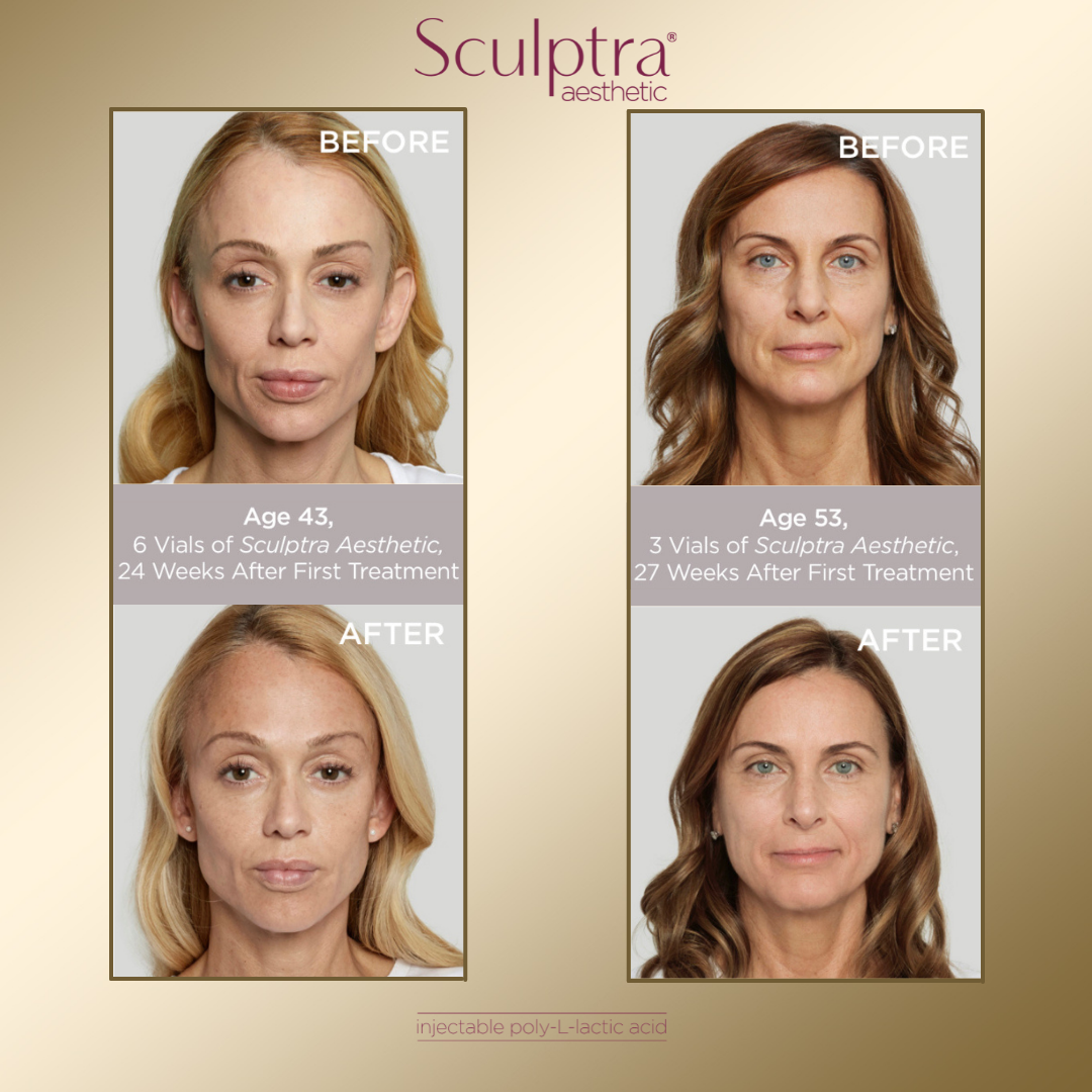 Sculptra available at Dermalogic