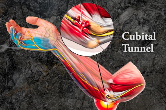 Ulnar Nerve Mobilization - when the funny bone ain't funny