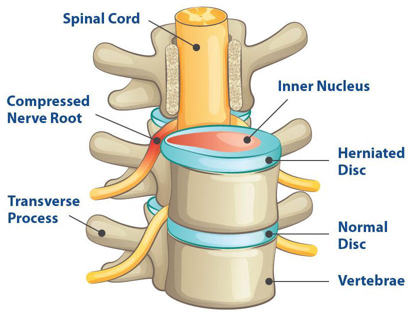What is Disc Herniation?
