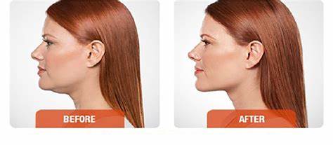 Remove Double Chin Fat With FREE Kybella