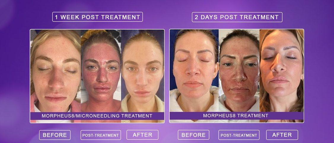 Introducing EXO ELIXIR™ Dermal Fibroblasts (DF) Exosomes