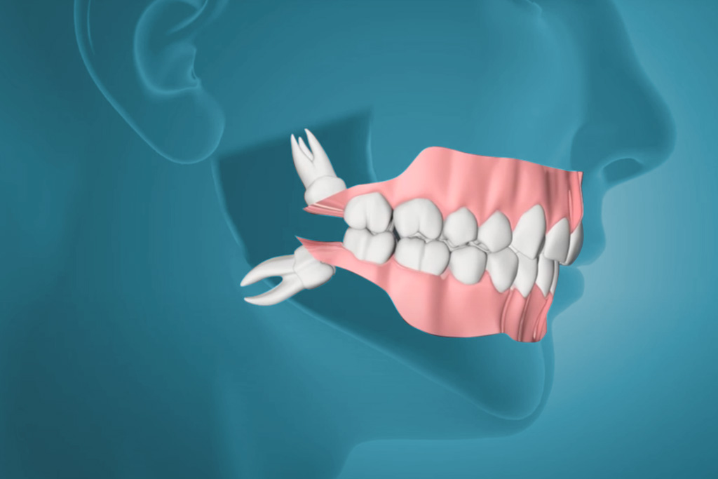 FREE Wisdom Teeth Consultation! 🍎