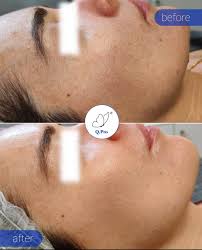Introducing The Chrysalis Peel: The Future of Non-Invasive Peels is Here