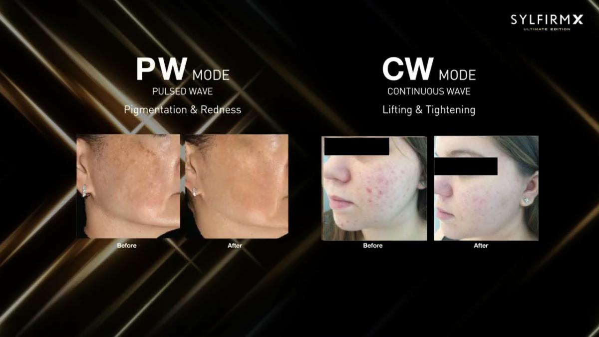 Why is the Sylfirm X considered the "Next Generation" in RF Microneedling?