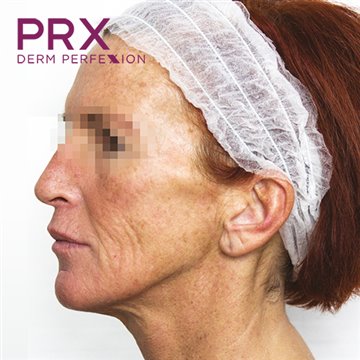 If you haven't added PRX treatments to your aesthetic practice yet ...