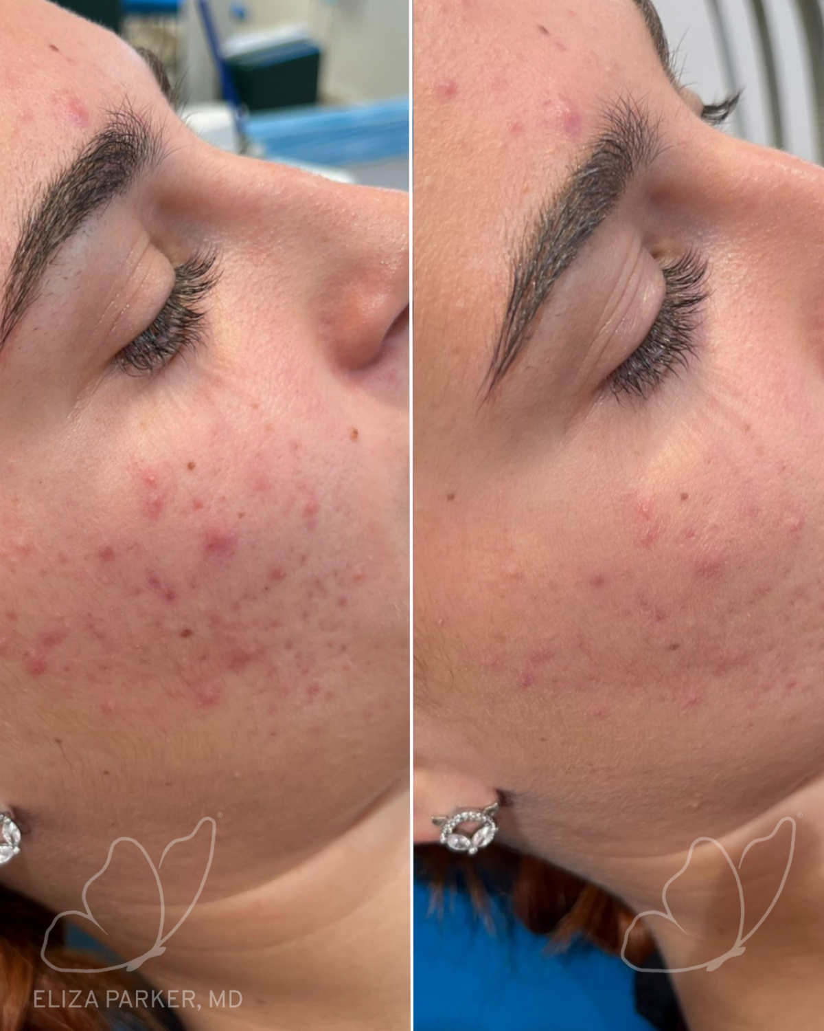 Introducing The Chrysalis Peel: The Future of Non-Invasive Peels is Here