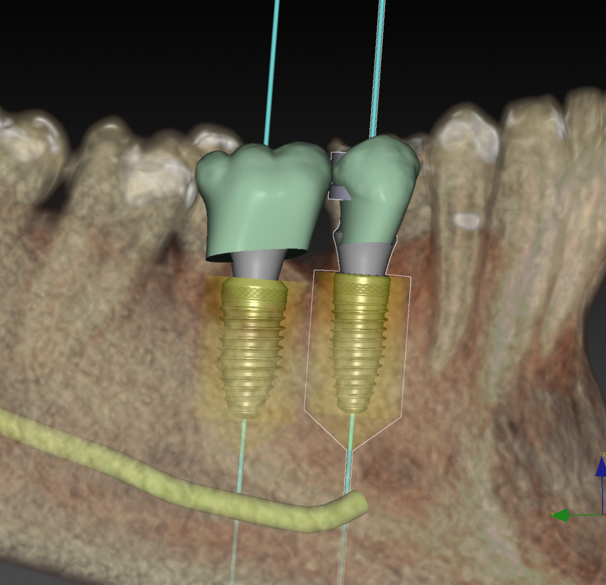 Plan, Print, Place & Guided Implants 🔩🦷