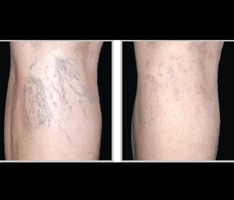 Instantaneously Eliminate Red Spider Veins.