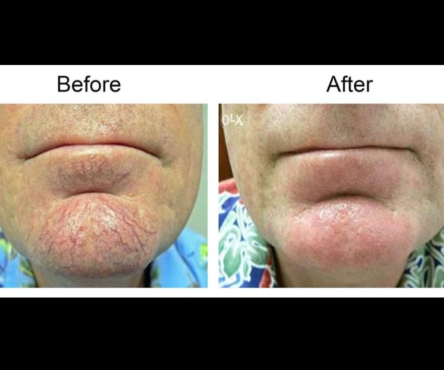 Instantaneously Eliminate Red Spider Veins.