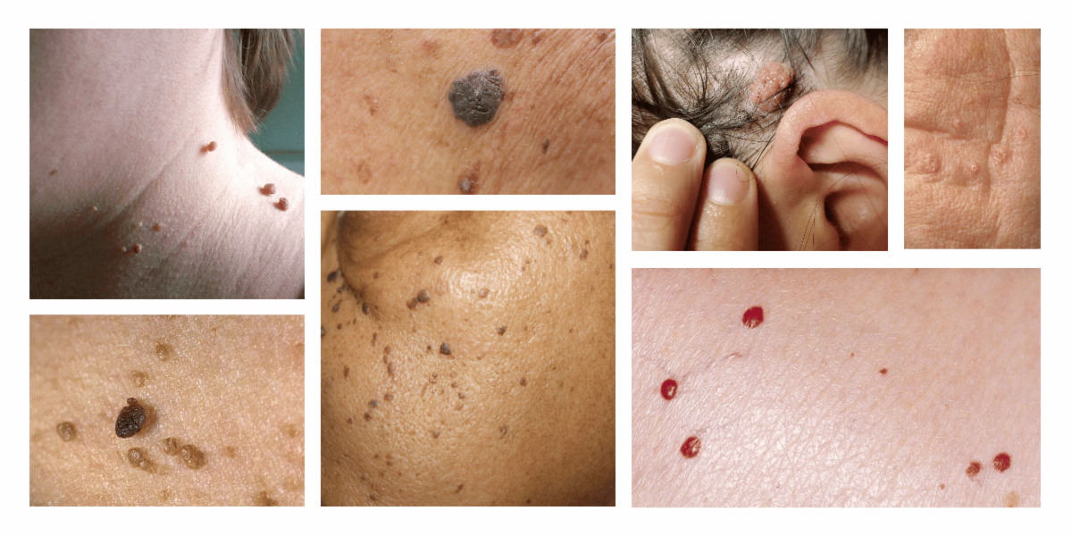 Are skin tags, moles, or age spots bothering you?