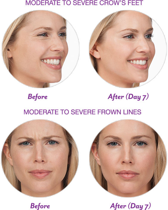 Come in for Memorial Day Week Botox Savings!