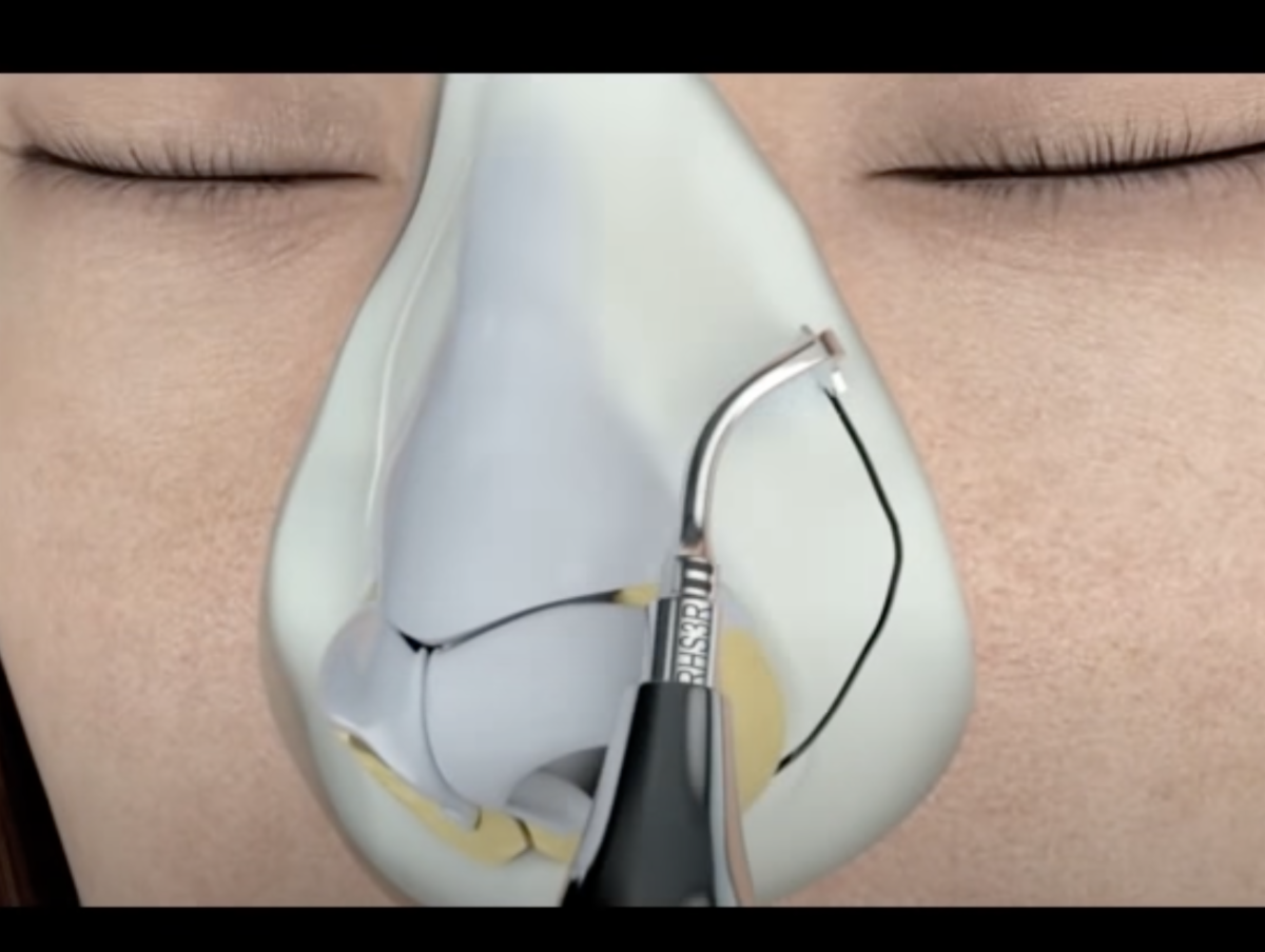 What is Piezo? Learn more about ultrasonic technology and its benefits ...