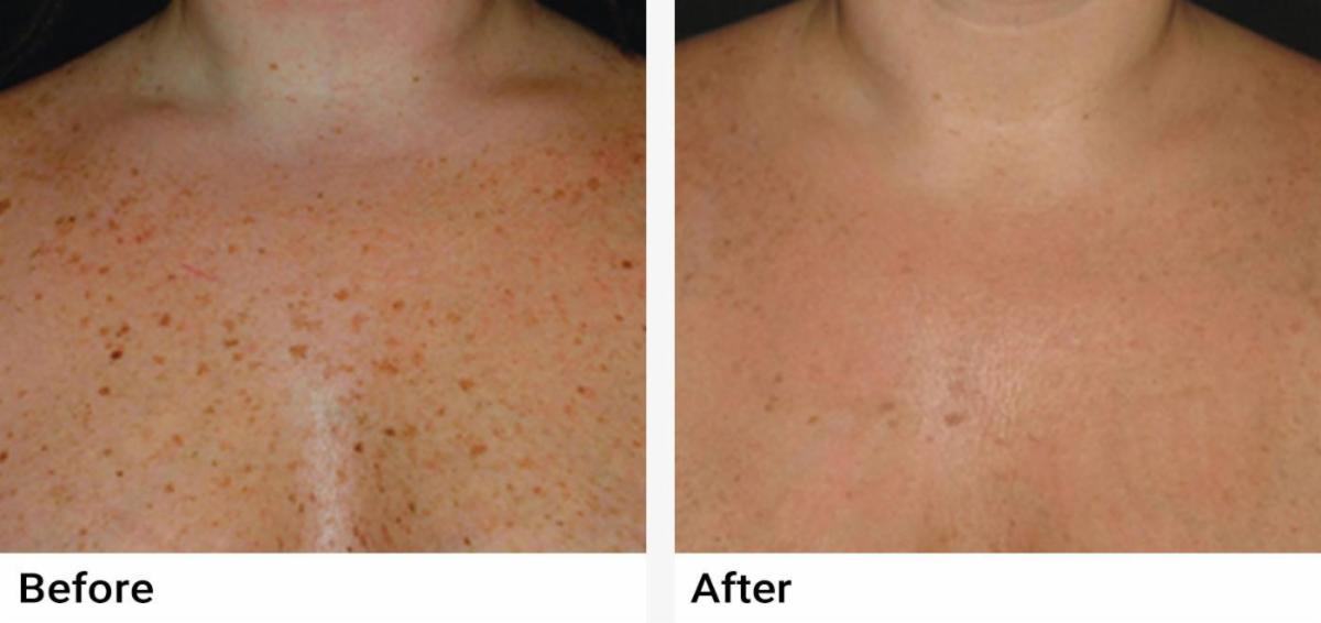 All these SAVINGS end Tomorrow for Tender Laser Care by jackie MED-SPA