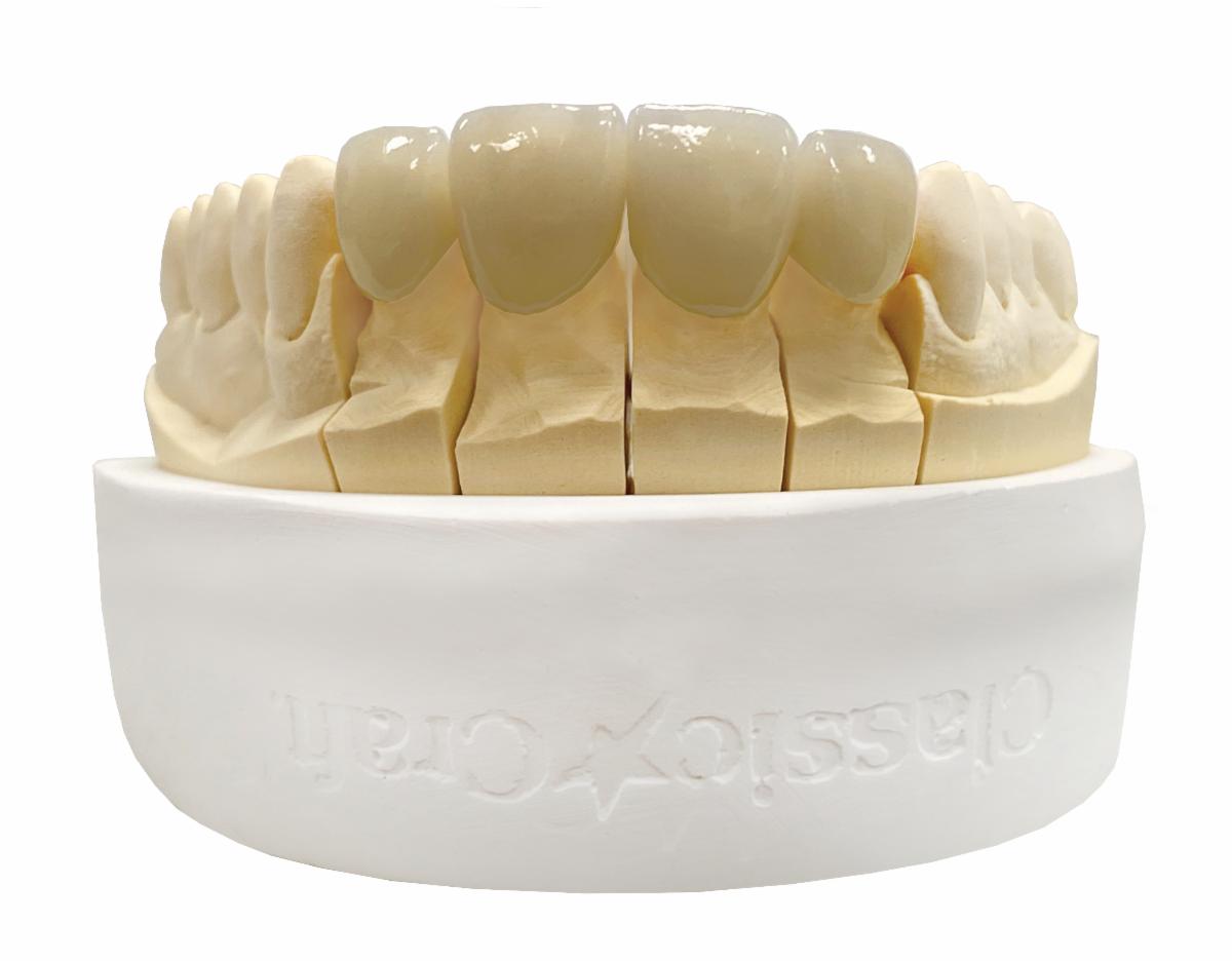 Benefits of IPS e.max