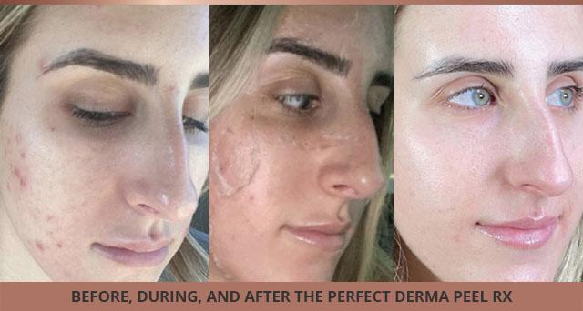 Summer Glow - $50 Off Your 1st Perfect Derma Peel