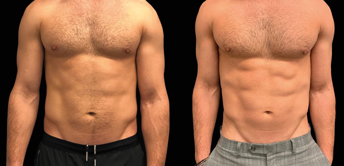 EMSculpting Package Price