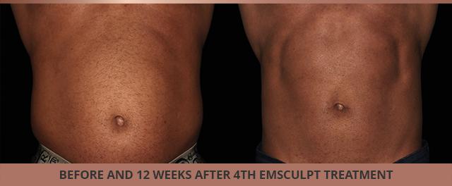 Sculpt your body with EMSculpt and Ultimate Contour - see immediate ...