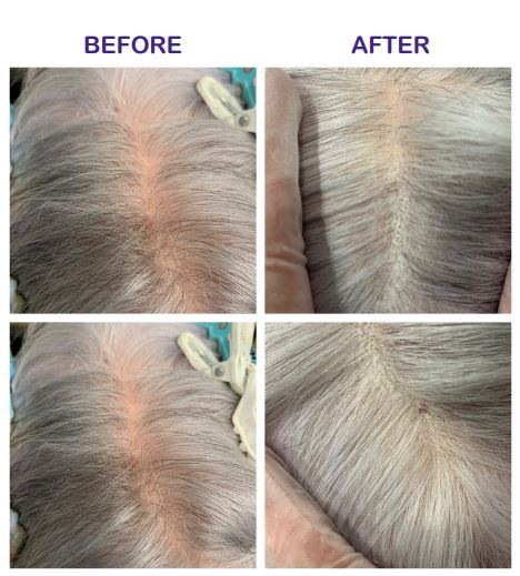 First and only FDA-approved injectable for cellulite at a $300 Discount ...