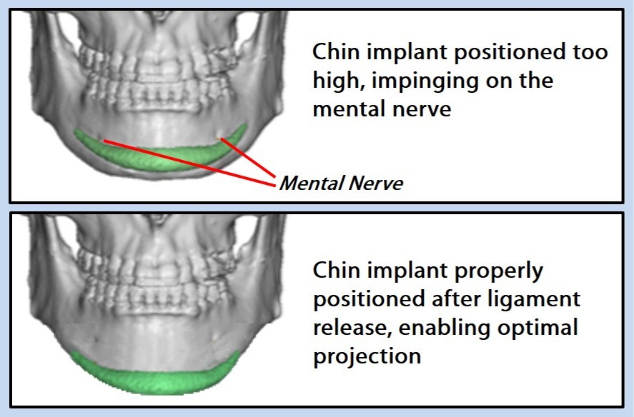 Spotlight on the ideal solution for concave temples