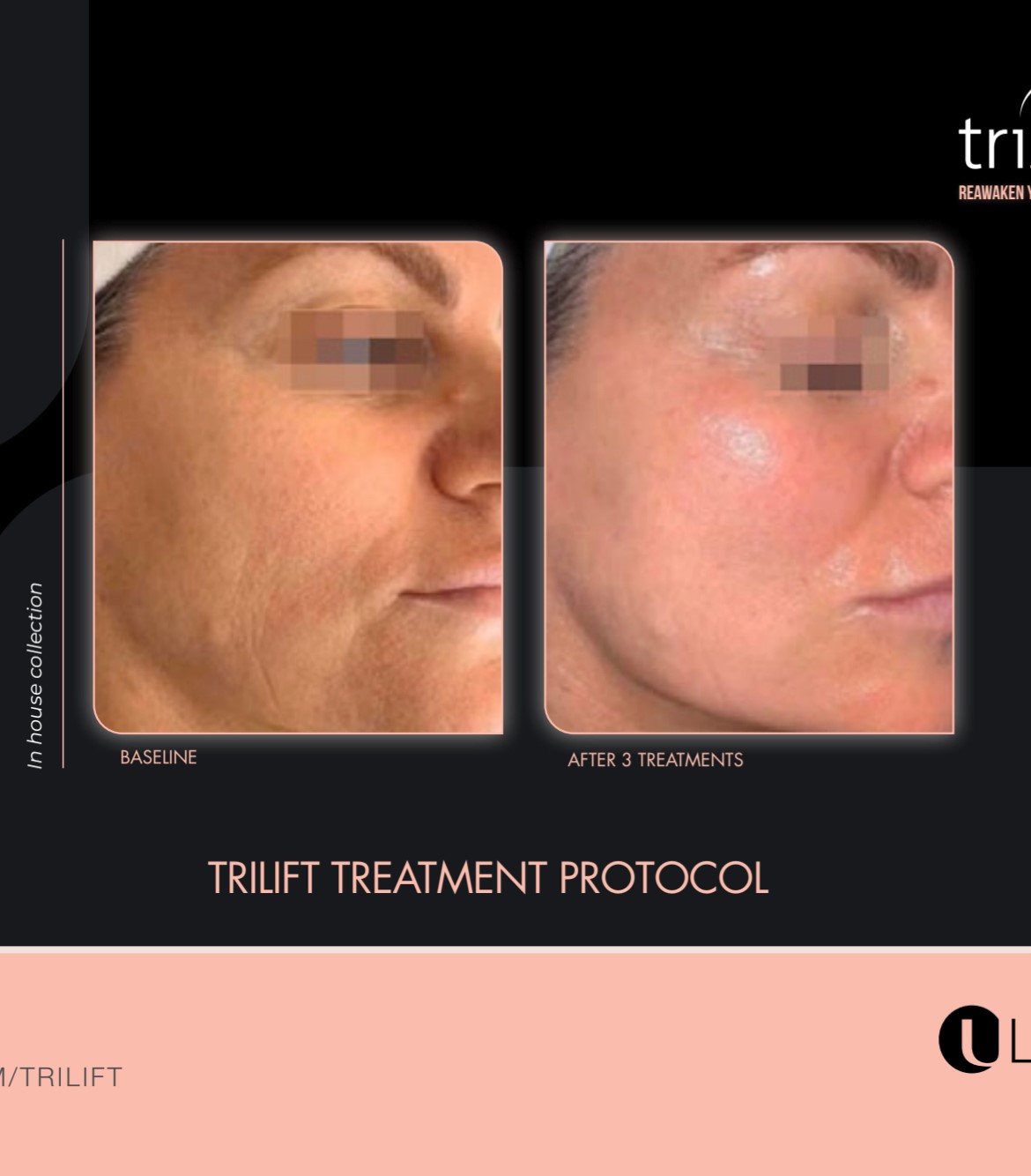 TriLift- The Non-surgical FaceLift