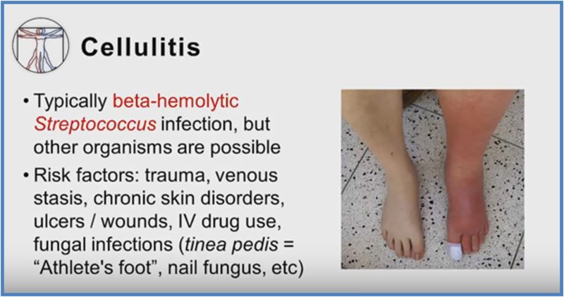 Impetigo, Erysipelas, Cellulitis: Diagnosis and Treatment